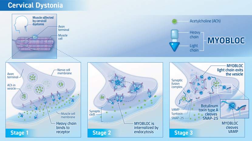 How MYOBLOC Helps Treat Cervical Dystonia